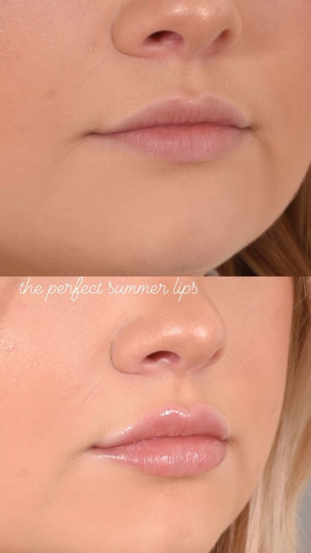 Hydrafacial® for Rochester, Victor & Syracuse, NY | Q the Medical Spa